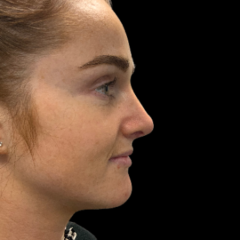 Ultrasonic rhinoplasty surgery before and after photos