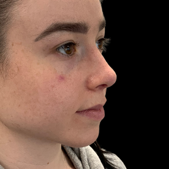Ultrasonic rhinoplasty surgery before and after photos