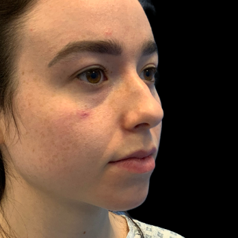 Ultrasonic rhinoplasty surgery before and after photos