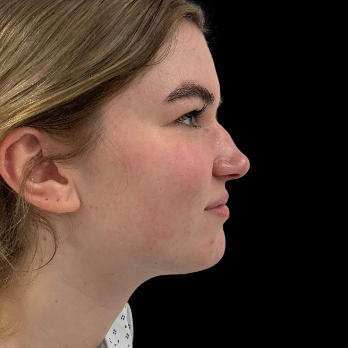 Preservation rhinoplasty surgery before and after photos
